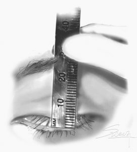 Droopy Eyelid Surgery – Ptosis Correction – SWENG PLASTIC AESTHETIC AND ...