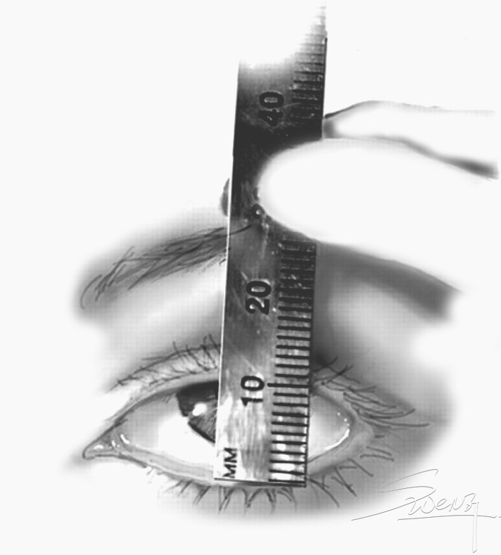 Droopy Eyelid Surgery – Ptosis Correction – SWENG PLASTIC AESTHETIC AND ...